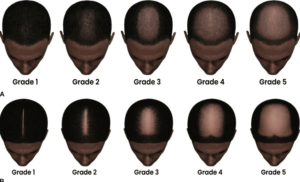 What Is Sinclair Scale? Sinclair Scale Scoring